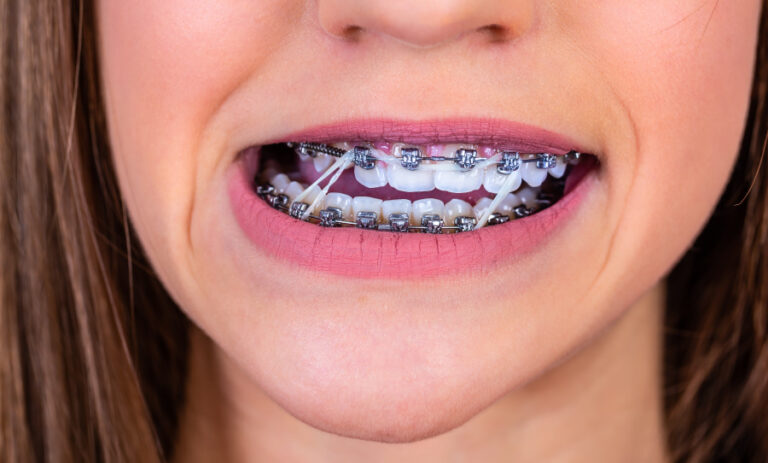 Orthodontic Braces Efficiency Enhanced With Rubber Band