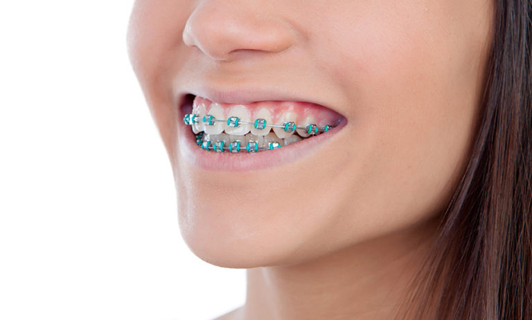 All about Braces in Alpharetta - NewPark Orthodontics