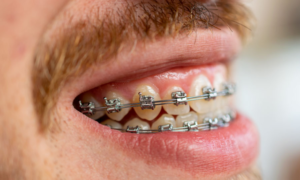 How Tooth Decay and Fillings Affect Braces - NewPark Orthodontics